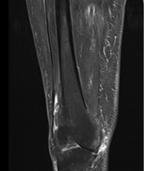 Revolutionizing Hip Fracture Tear Imaging: The Role of STIR MRI ...